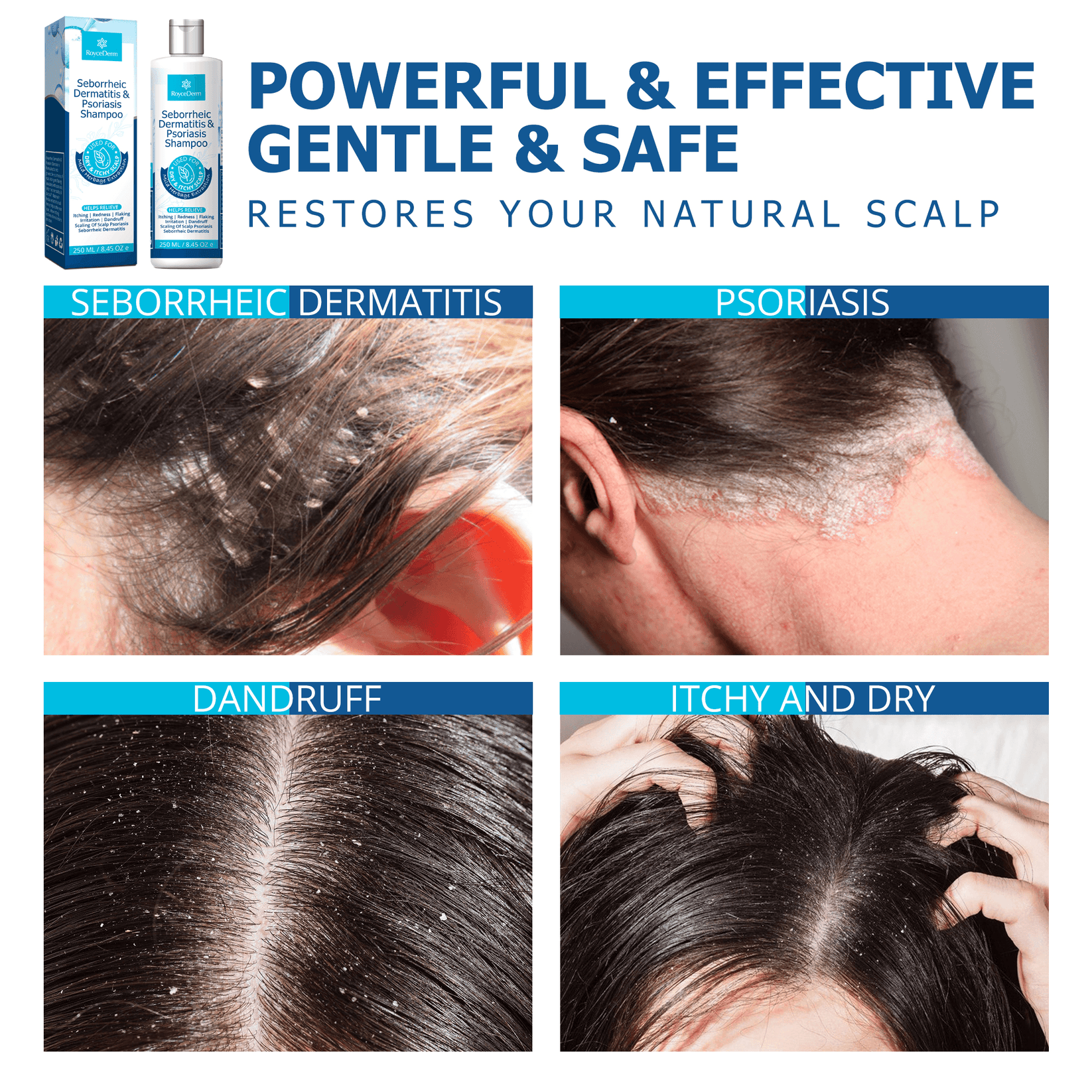 Psoriasis & Seborrheic Dermatitis Shampoo – Roycederm