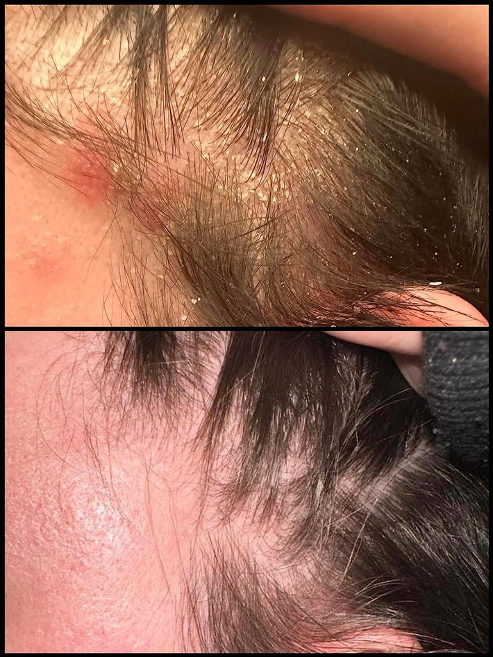 Roycederm | Advanced Anti-Fungal & Skin Care Solutions