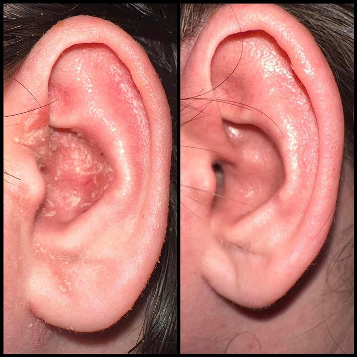 Roycederm | Advanced Anti-Fungal & Skin Care Solutions