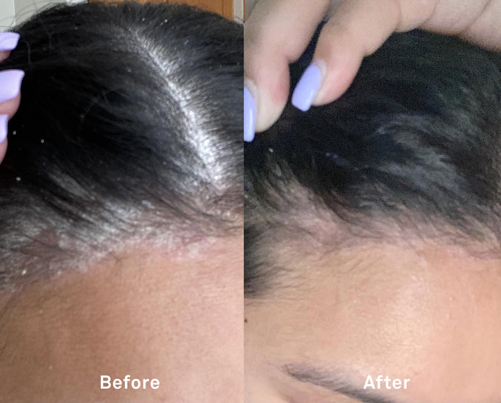 Roycederm | Advanced Anti-Fungal & Skin Care Solutions