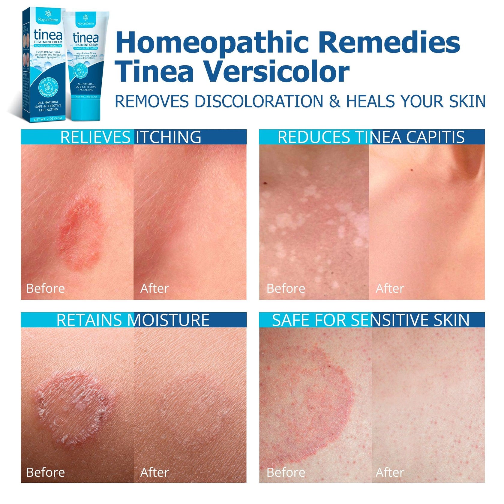 Tinea Versicolor Treatment: Fast Healing Anti-Fungal Skin Cream for Ti ...