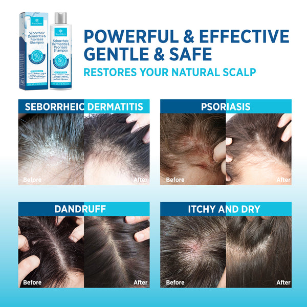 Psoriasis & Seborrheic Dermatitis Shampoo – Roycederm